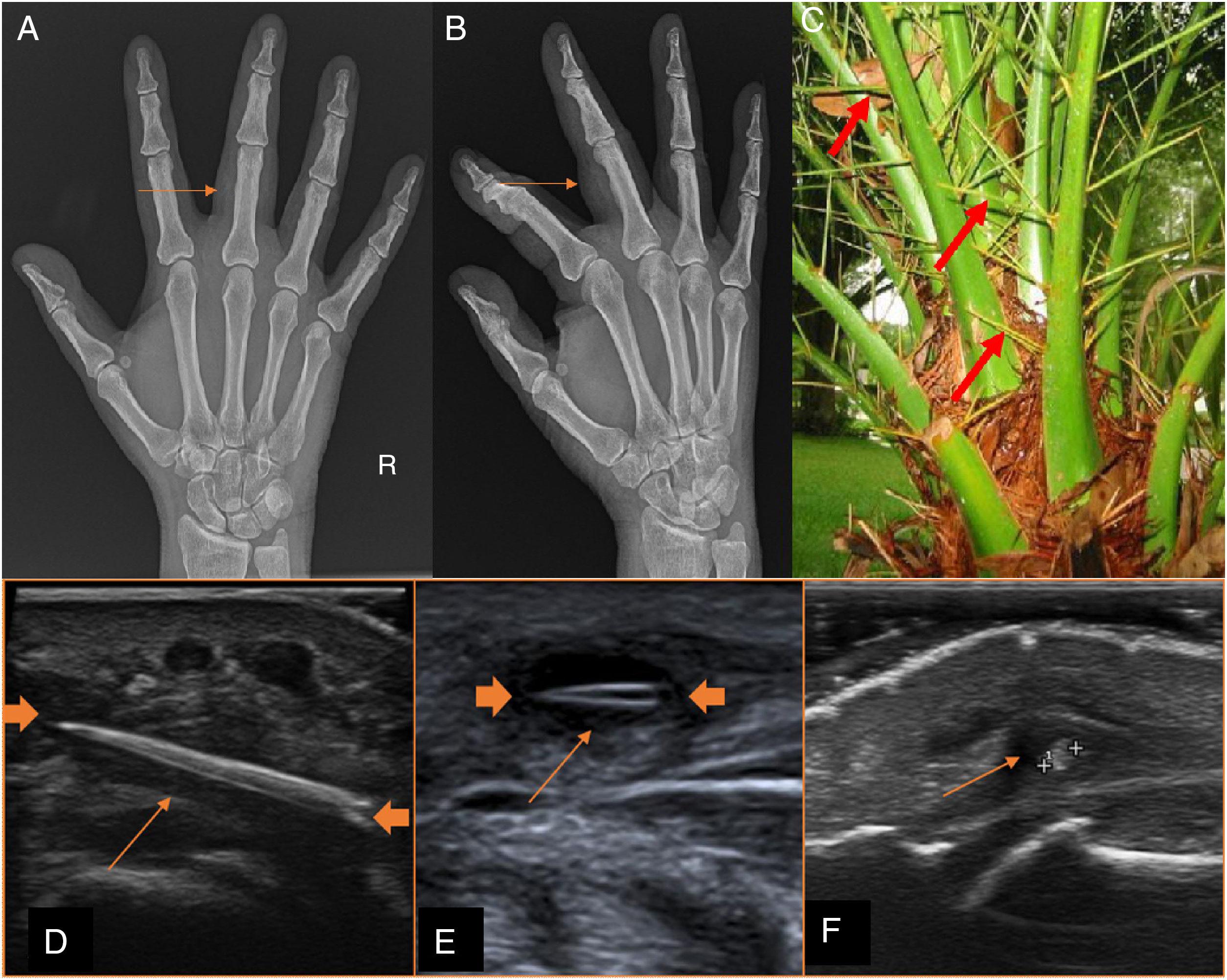 Ultrasonography of subcutaneous foreign bodies: differences depending ...