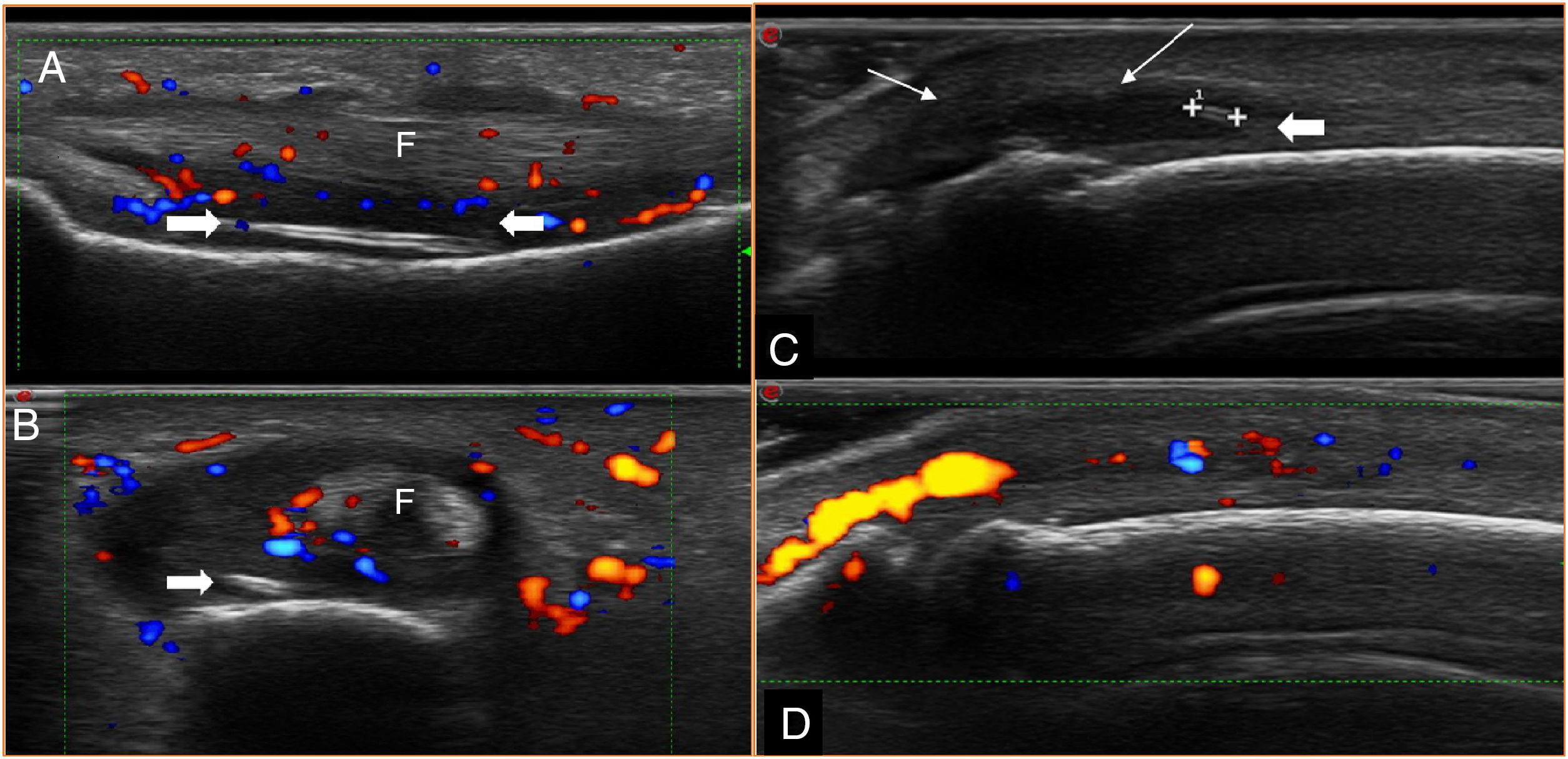 Ultrasonography of subcutaneous foreign bodies: differences depending ...