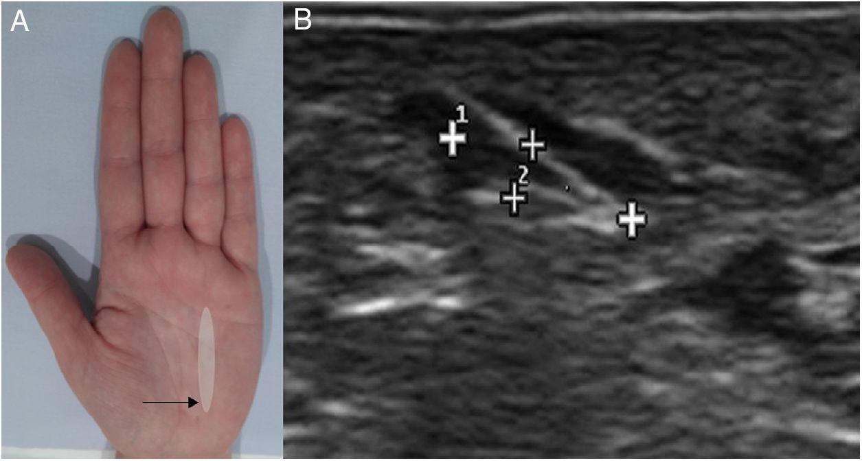 Ultrasonography of subcutaneous foreign bodies: differences depending ...