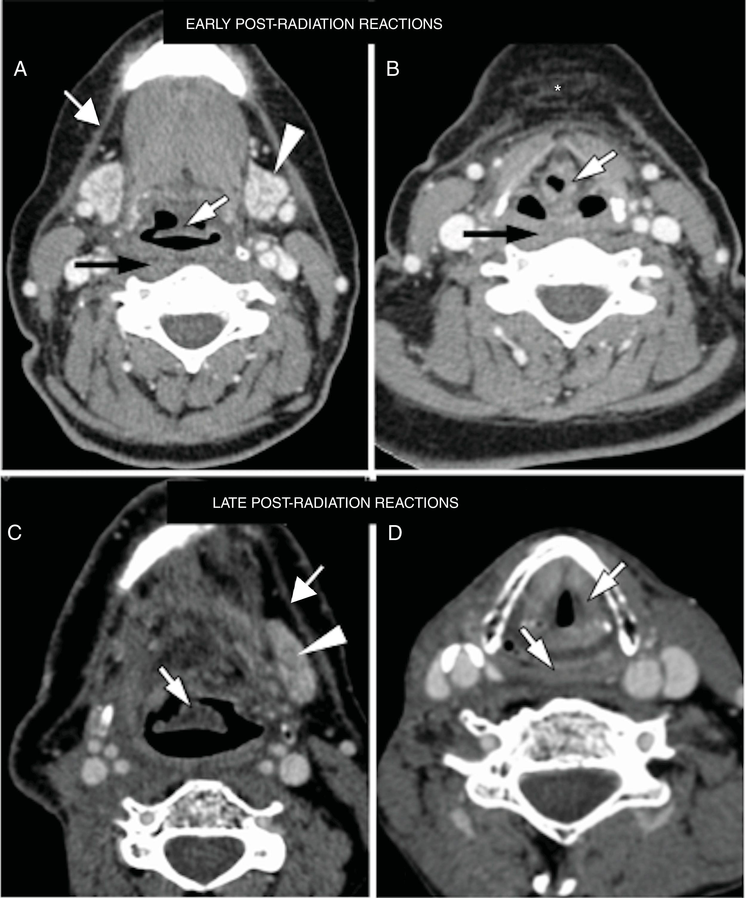 Follow-up in head and neck cancer. What the radiologist must know ...