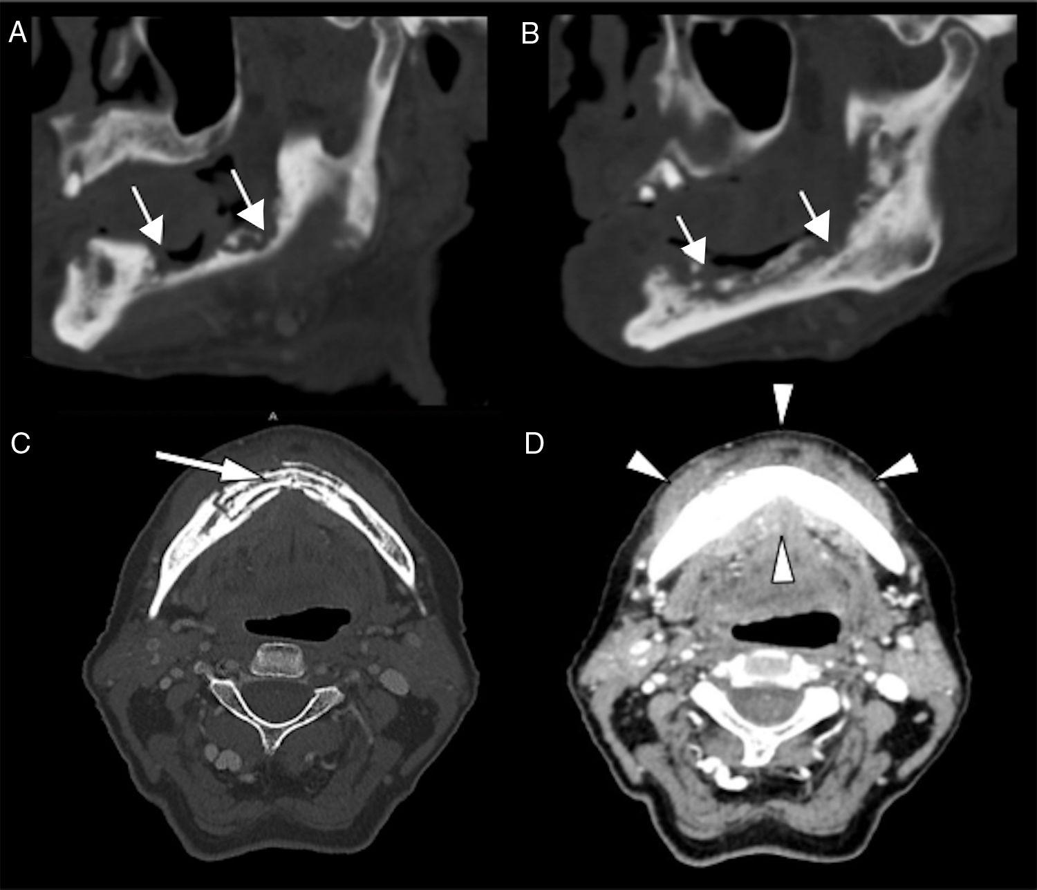 Follow-up in head and neck cancer. What the radiologist must know ...