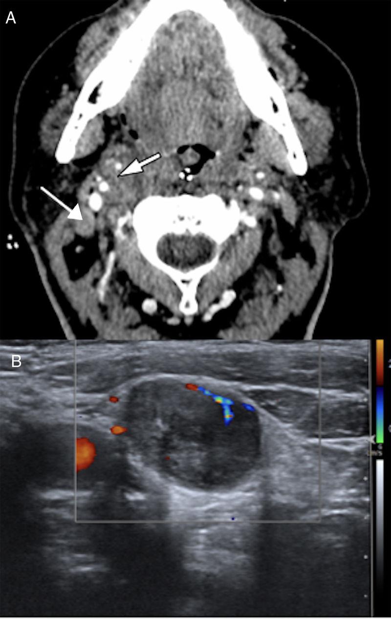 Follow-up in head and neck cancer. What the radiologist must know ...