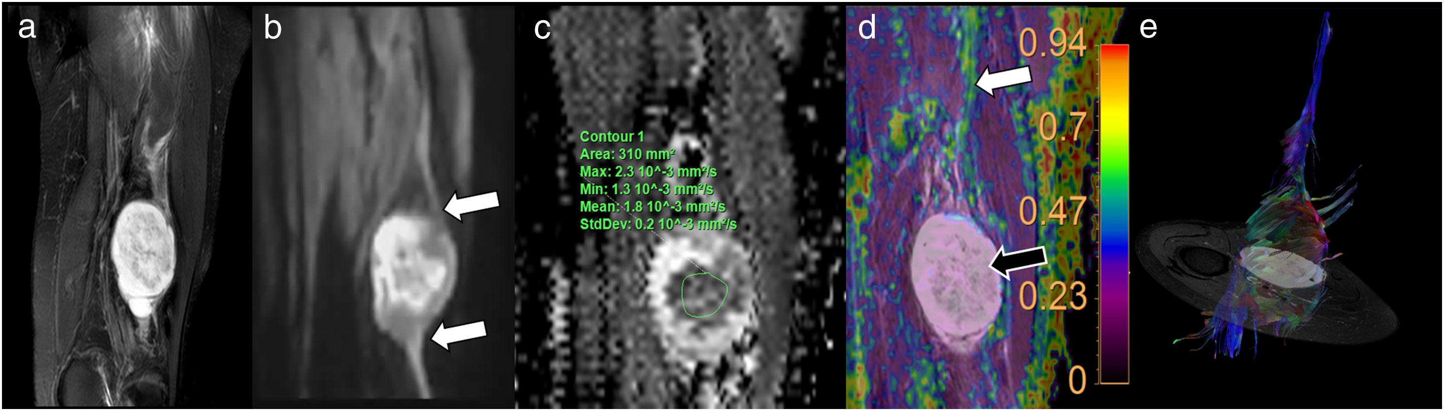 Update in the evaluation of peripheral nerves by MRI, from ...