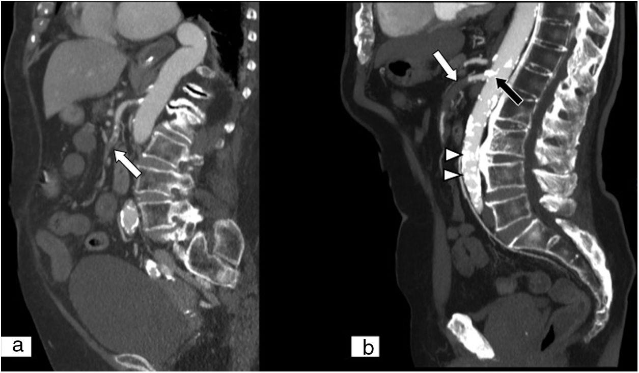 Acute mesenteric ischemia: A review of the main imaging techniques and ...