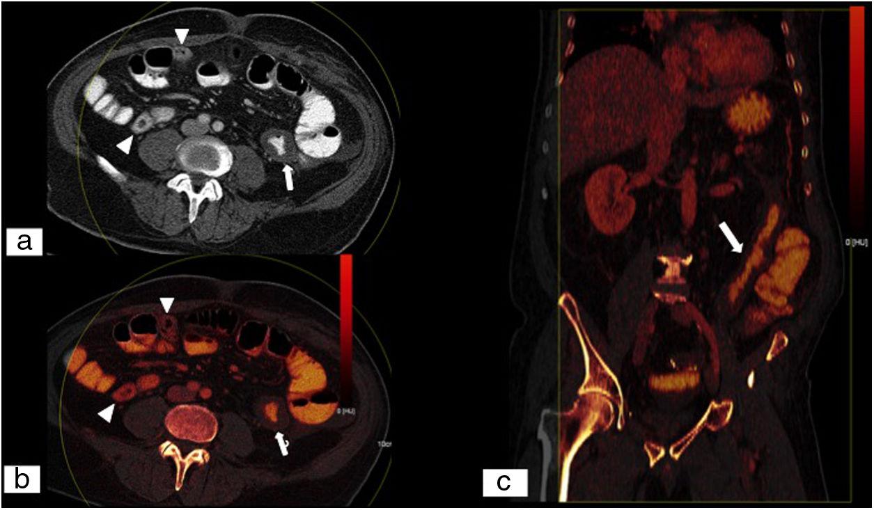 Acute mesenteric ischemia: A review of the main imaging techniques and ...