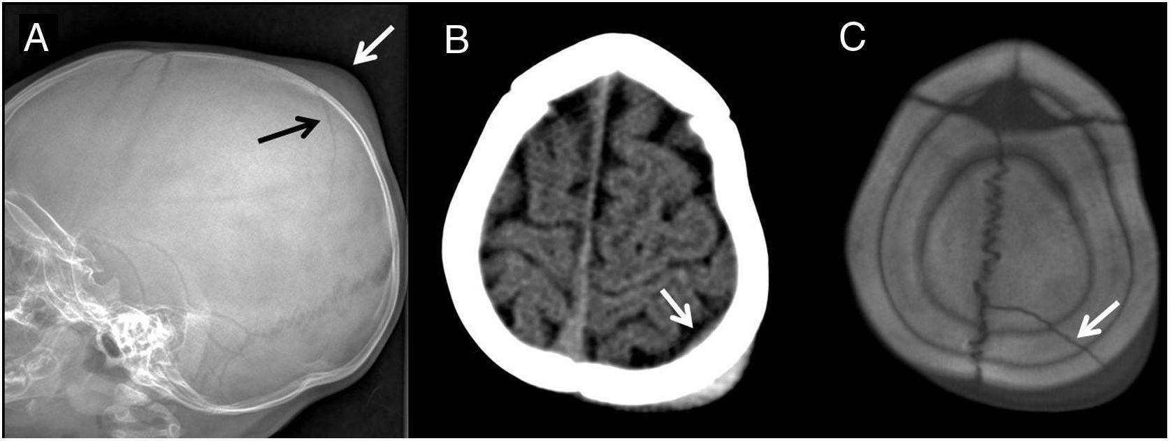 Linear skull fracture in infants after mild traumatic brain injury ...