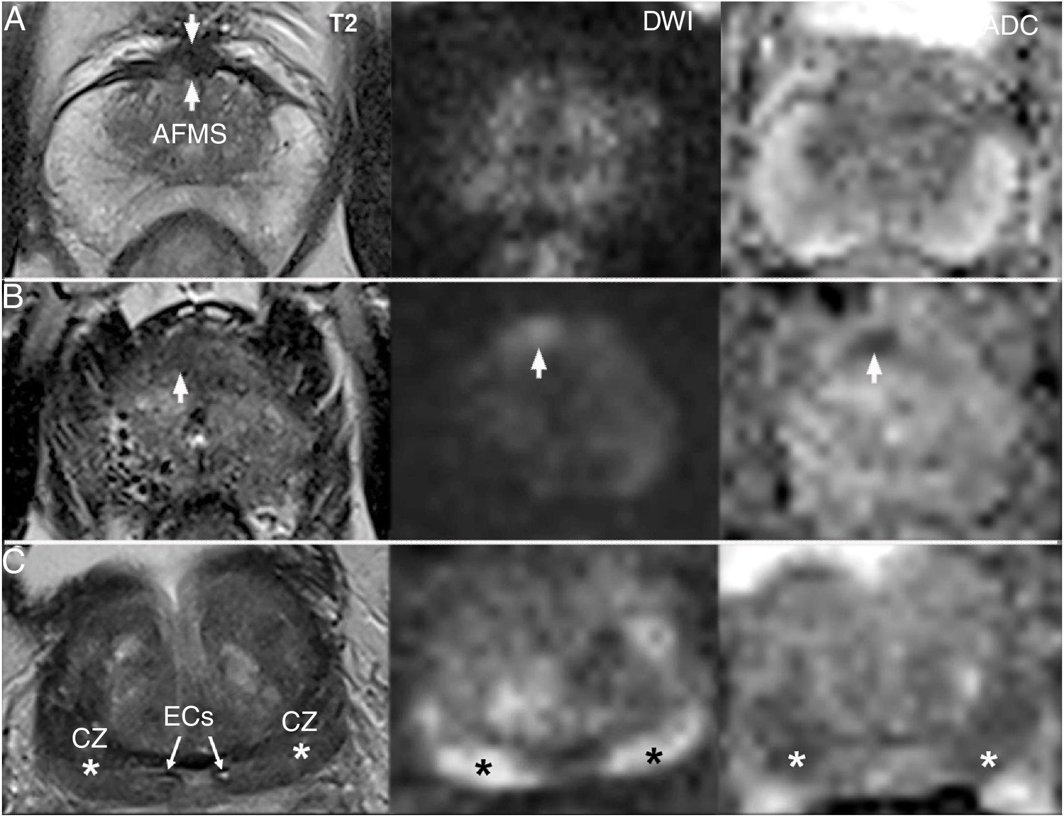 Prostate MRI: Practical guidelines for interpreting and reporting ...