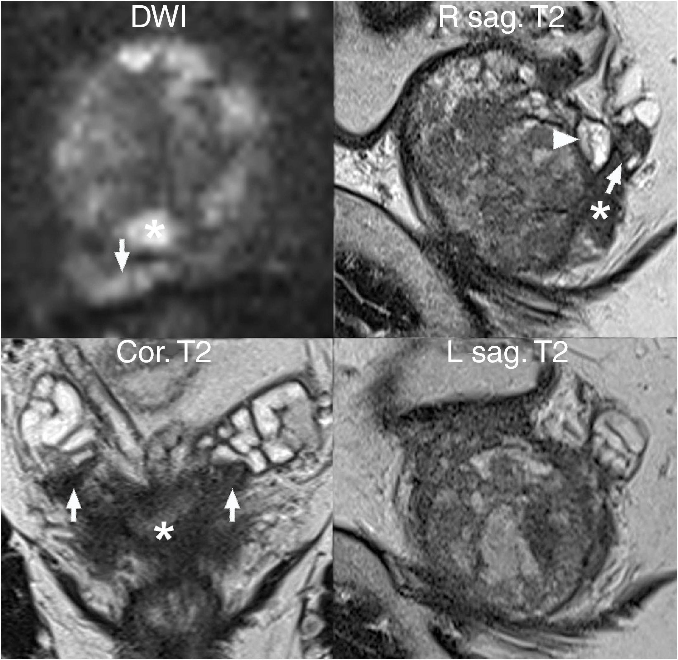 Prostate MRI: Practical guidelines for interpreting and reporting ...