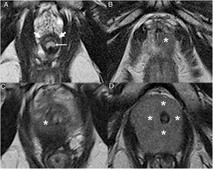 Prostate MRI: Practical guidelines for interpreting and reporting ...