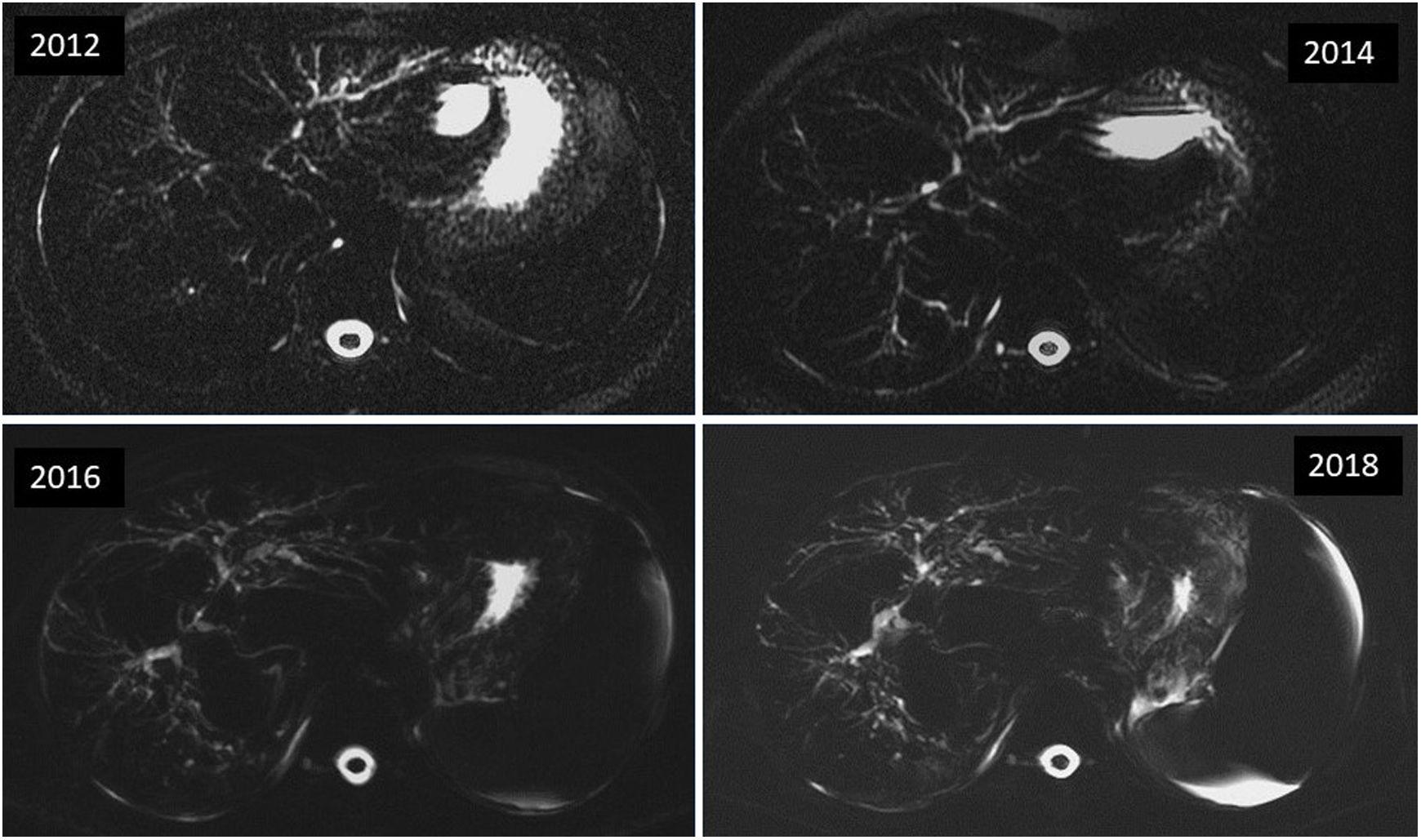 Chronic cholangitis: Differential diagnosis and role of MRI ...