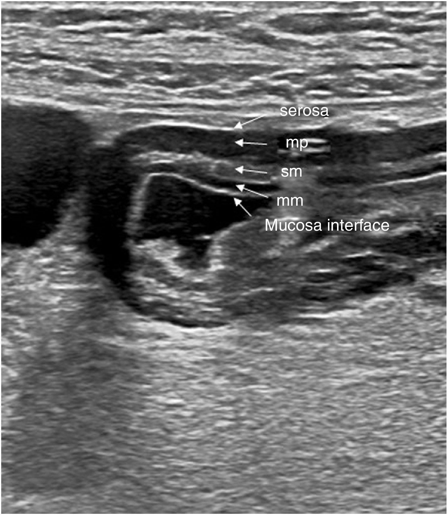 Bowel ultrasound: Examination techniques and normal and pathologic ...