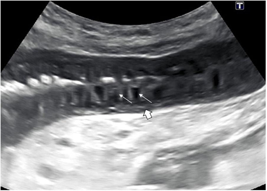 Bowel ultrasound: Examination techniques and normal and pathologic ...