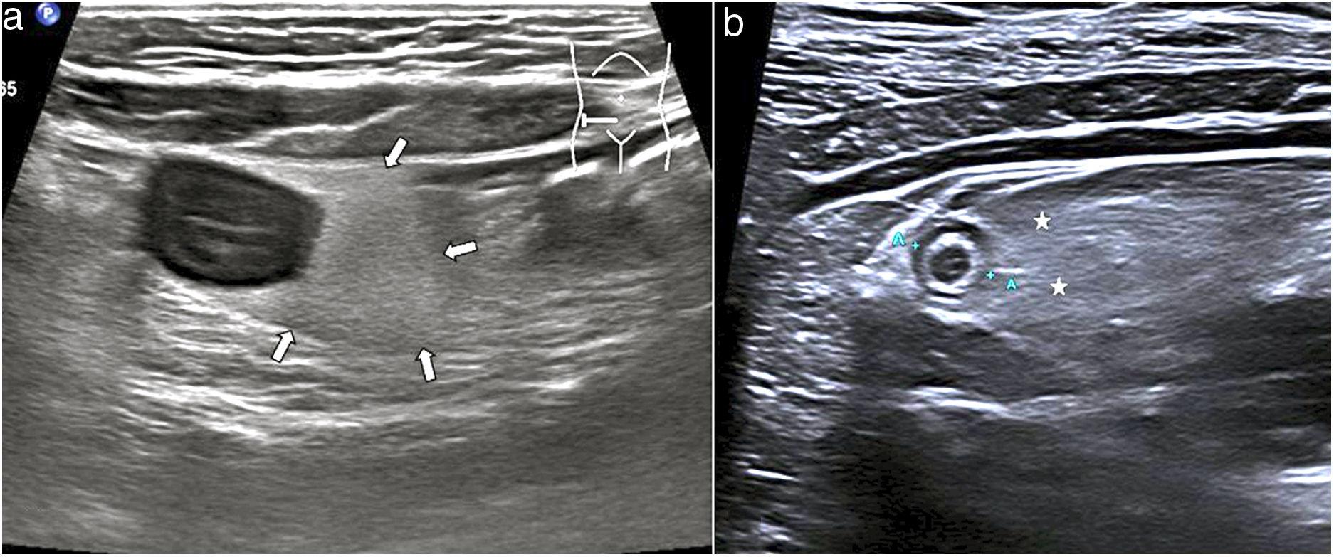 Bowel ultrasound: Examination techniques and normal and pathologic ...