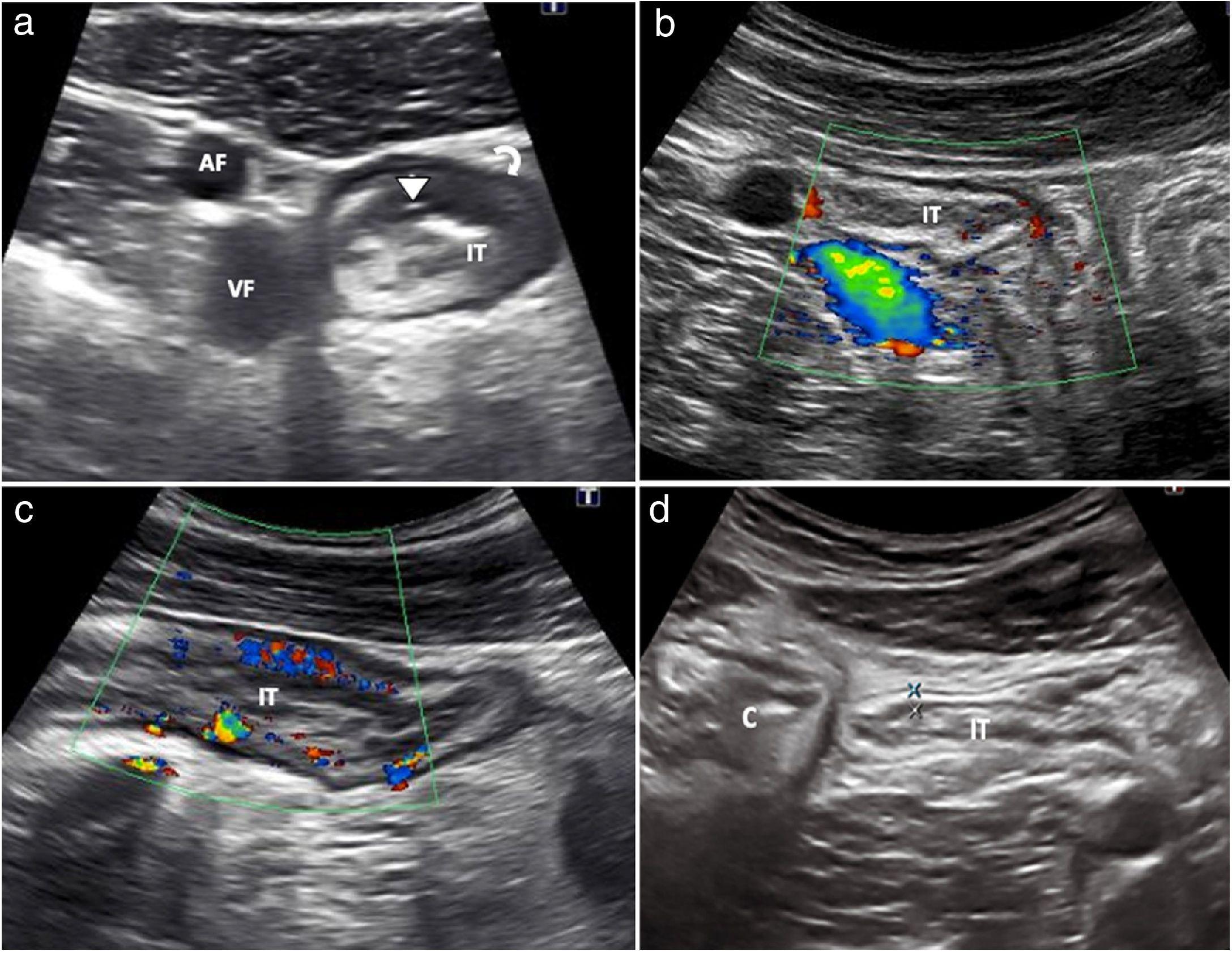 Terminal Ileum Ultrasound