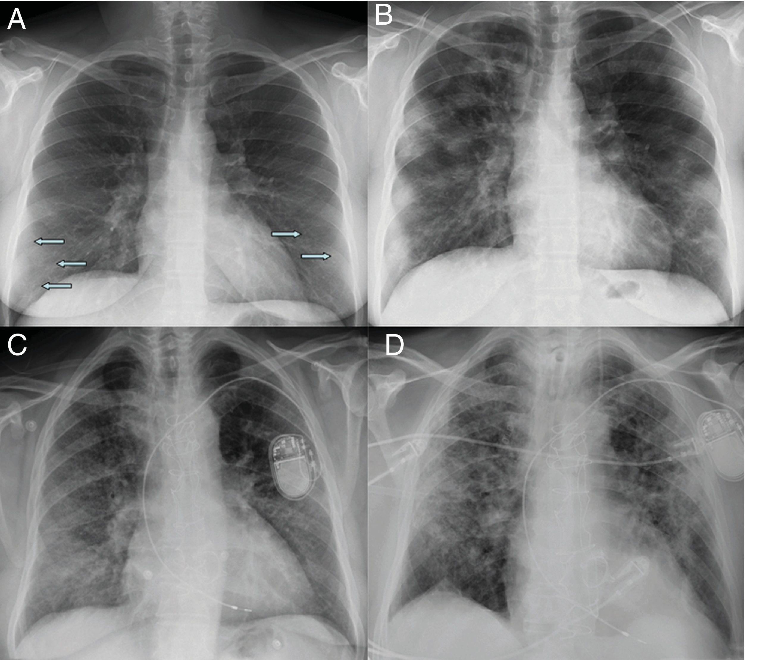 Lingular Pneumonia