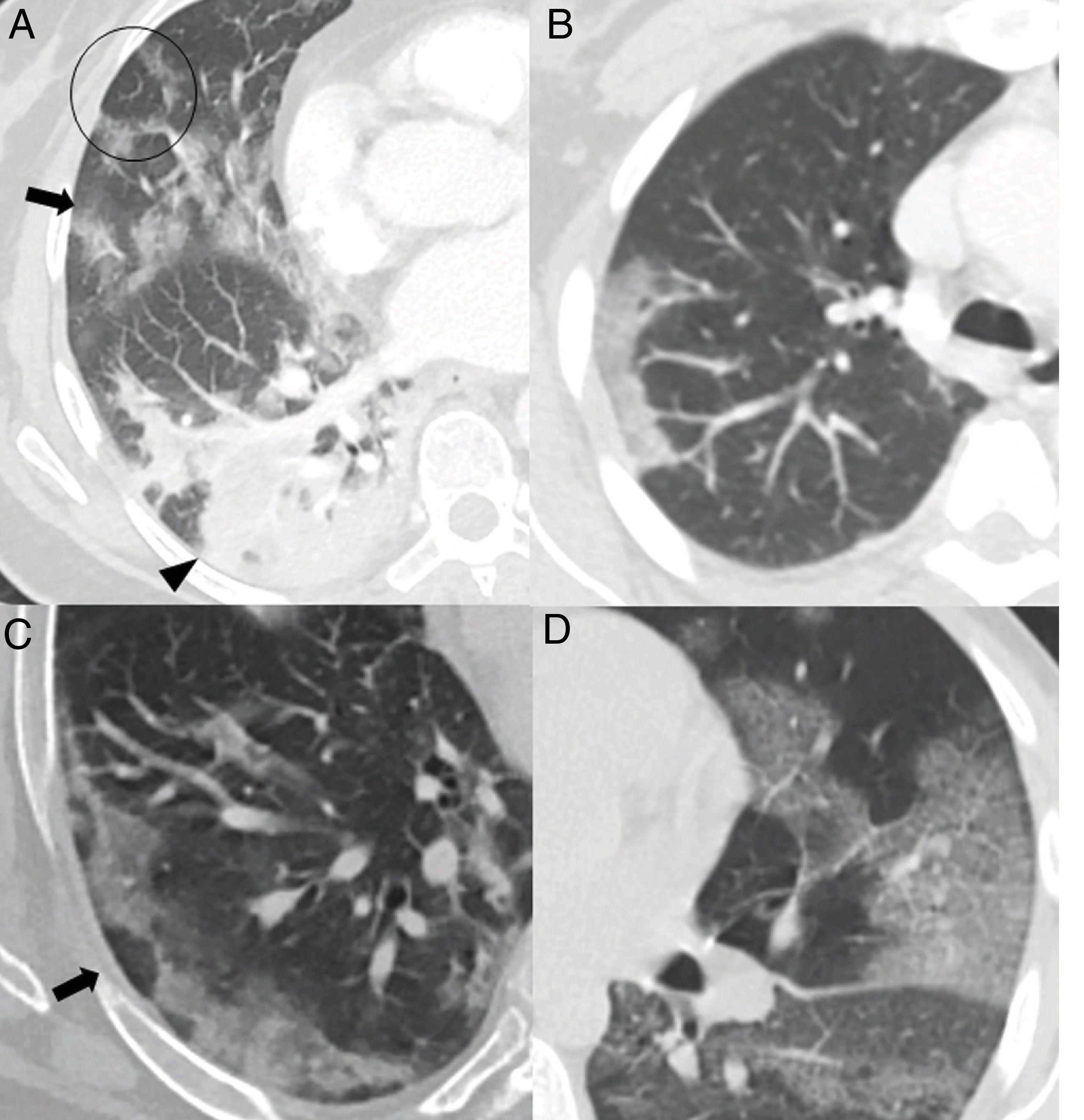 Radiologic aspects of COVID-19 pneumonia: Outcomes and thoracic ...