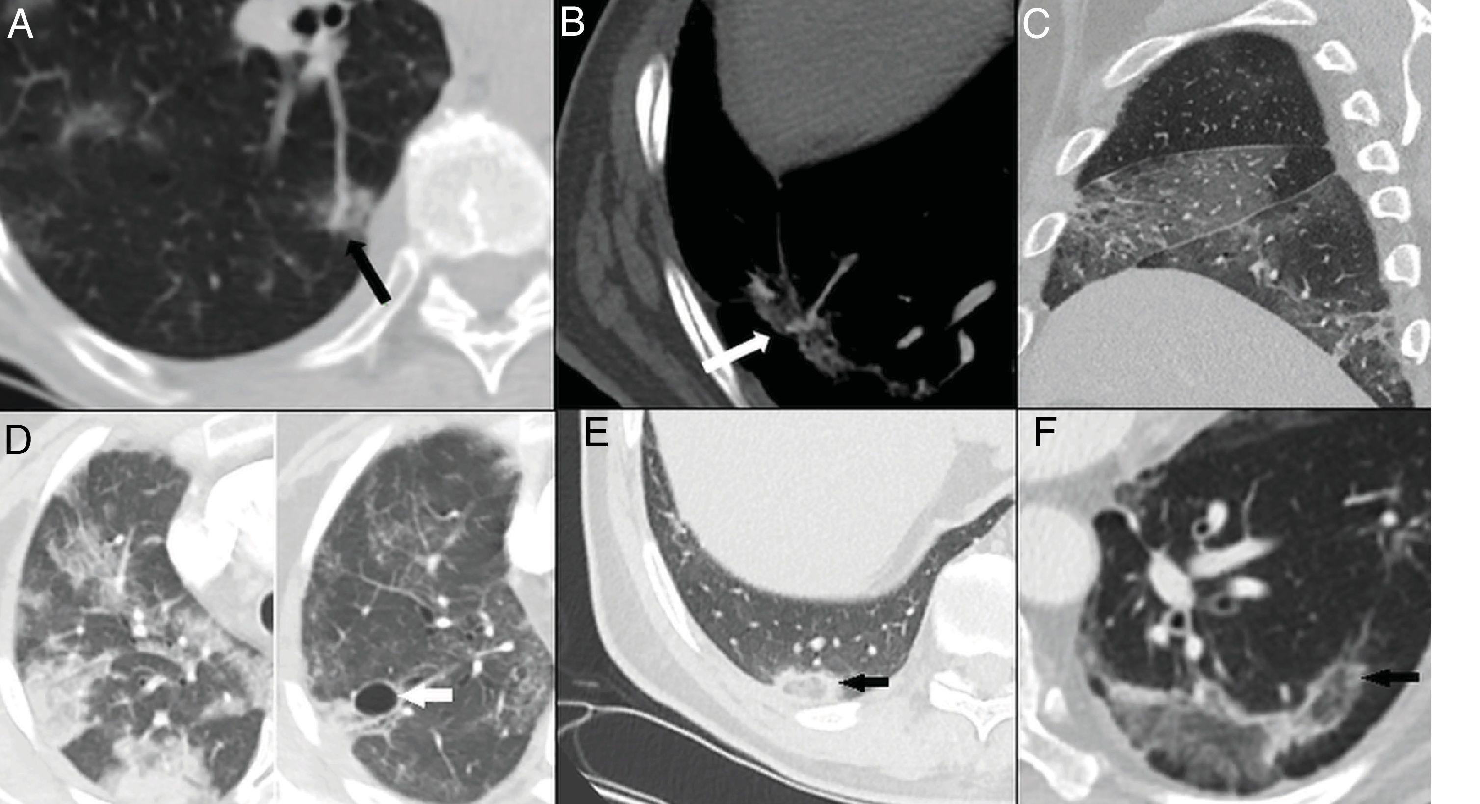 Radiologic aspects of COVID-19 pneumonia: Outcomes and thoracic ...