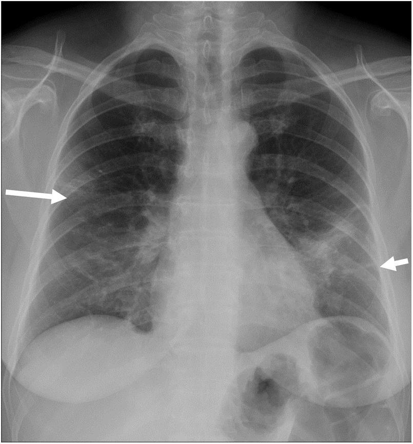 Copd Chest X Ray Frequency