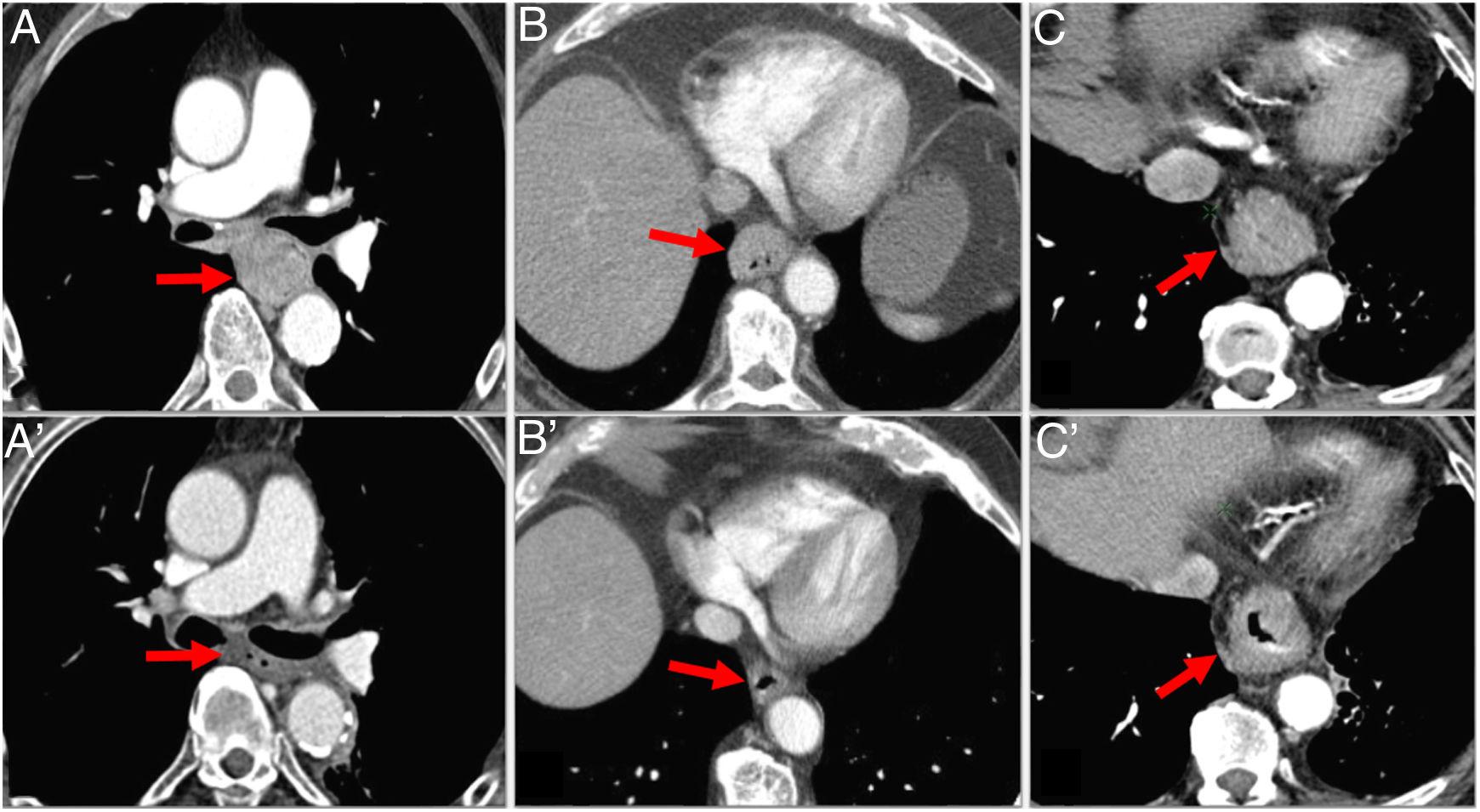 An updated review of the TNM classification system for cancer of the ...