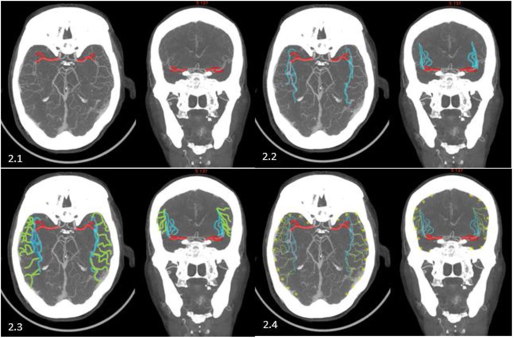Middle Cerebral Artery Superior Division
