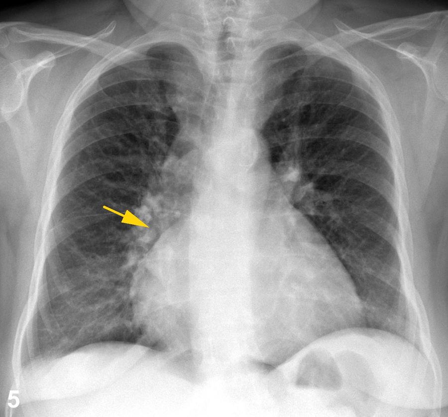 The hilum of the lung: Two classical radiological signs to decipher it ...