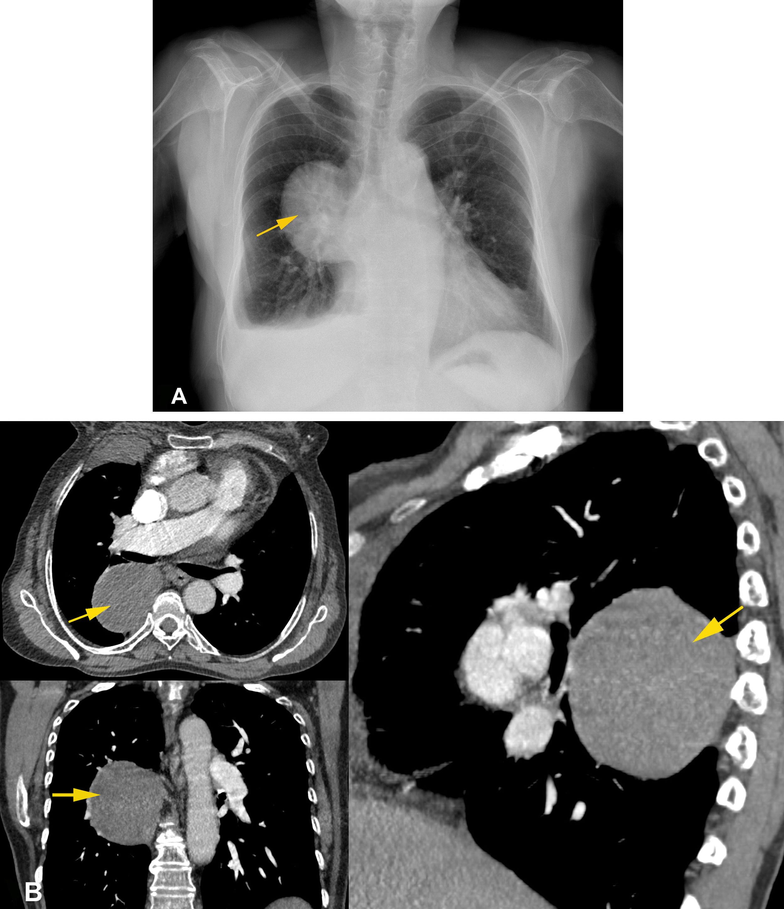 The hilum of the lung: Two classical radiological signs to decipher it ...
