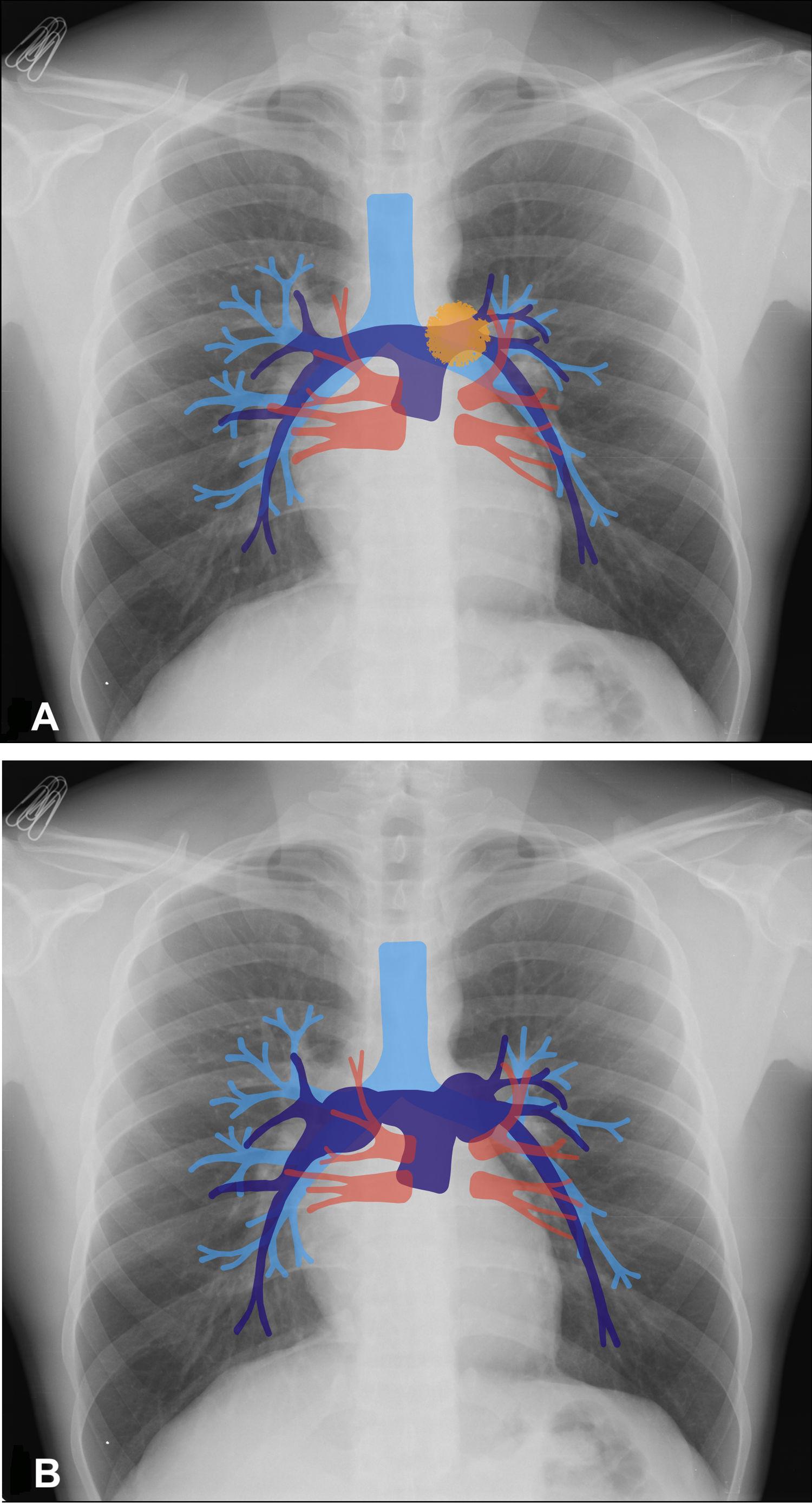 The hilum of the lung: Two classical radiological signs to decipher it ...