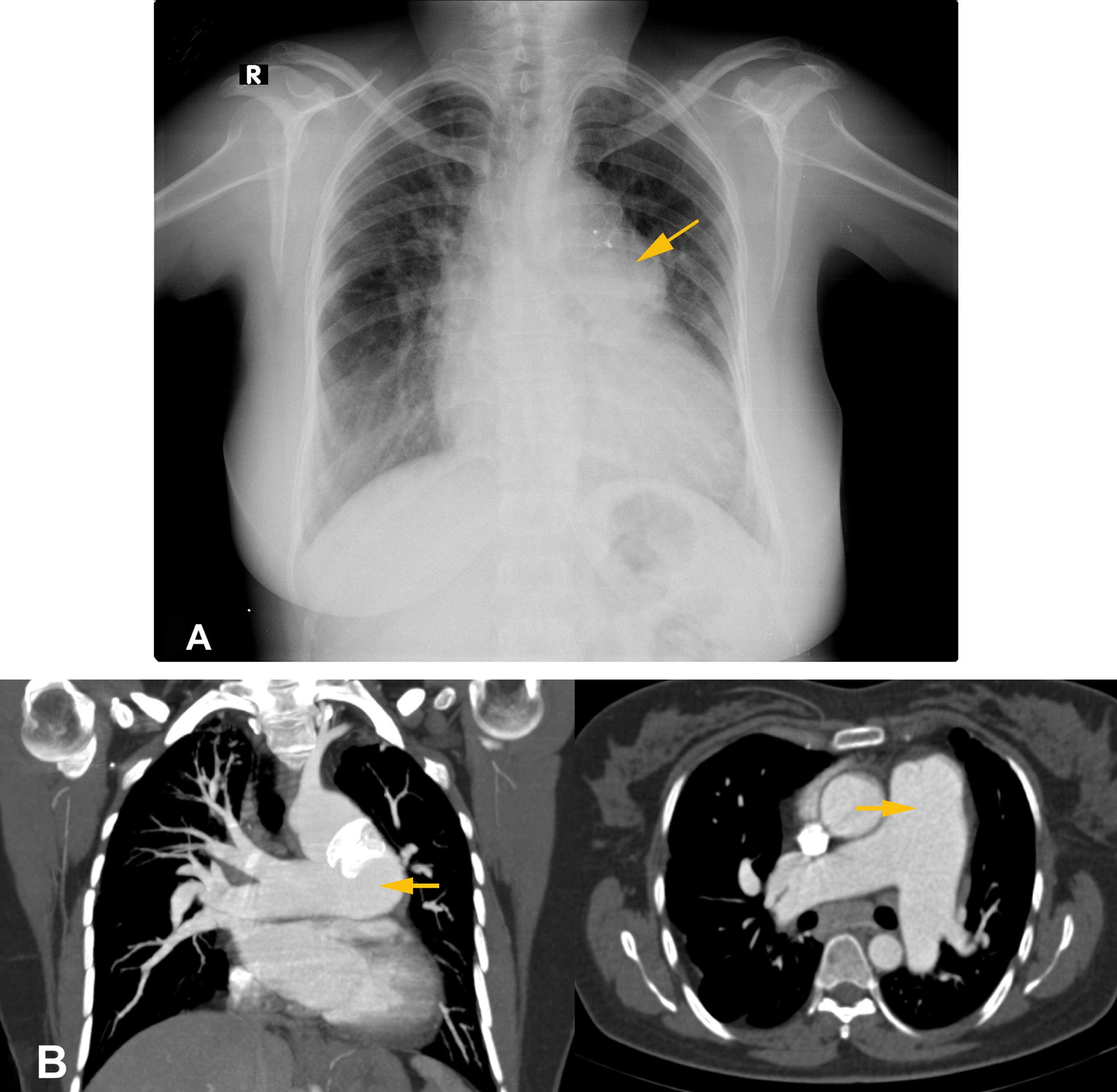 The hilum of the lung: Two classical radiological signs to decipher it ...