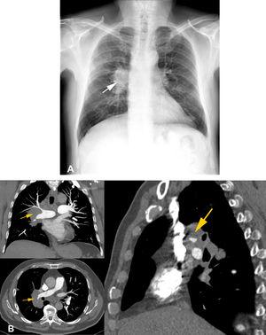 The hilum of the lung: Two classical radiological signs to decipher it ...