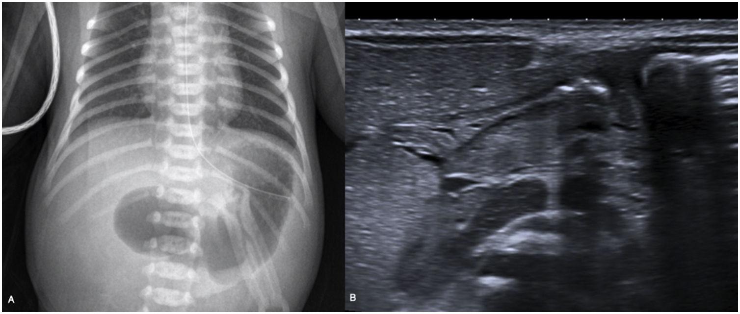 Jejunal Atresia X Ray