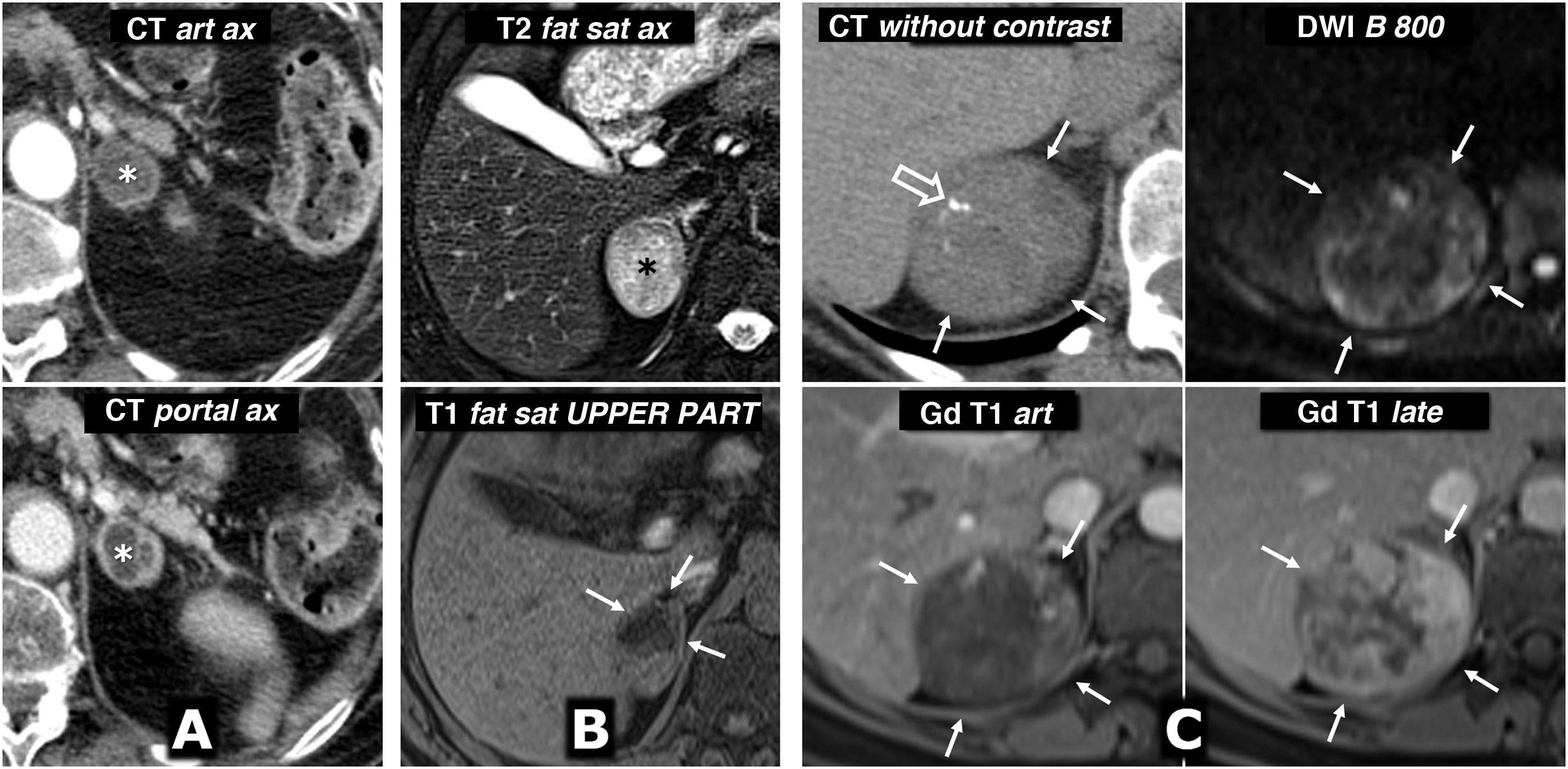 Adrenal pheochromocytoma: Keys to radiologic diagnosis | Radiología ...