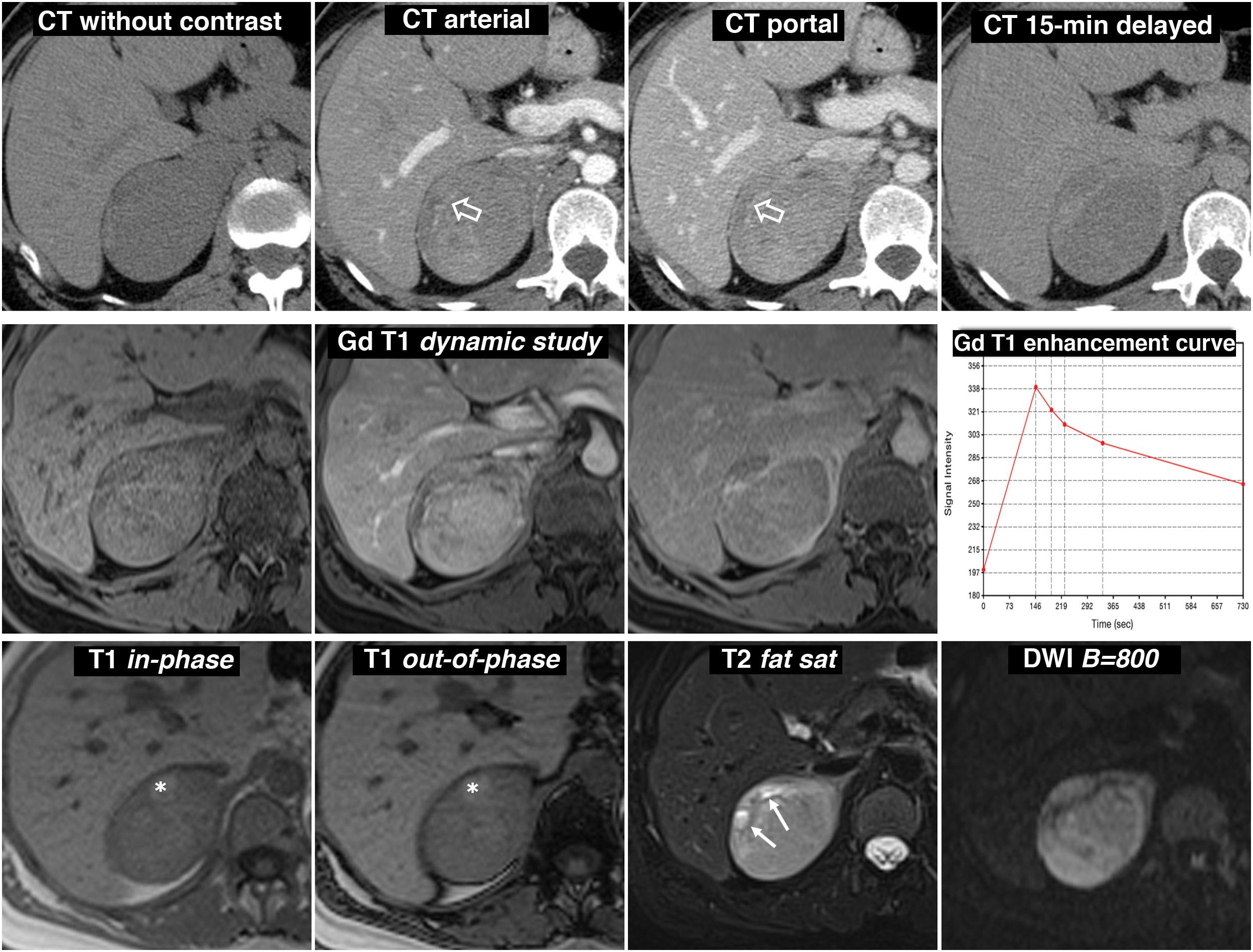Adrenal pheochromocytoma: Keys to radiologic diagnosis | Radiología ...