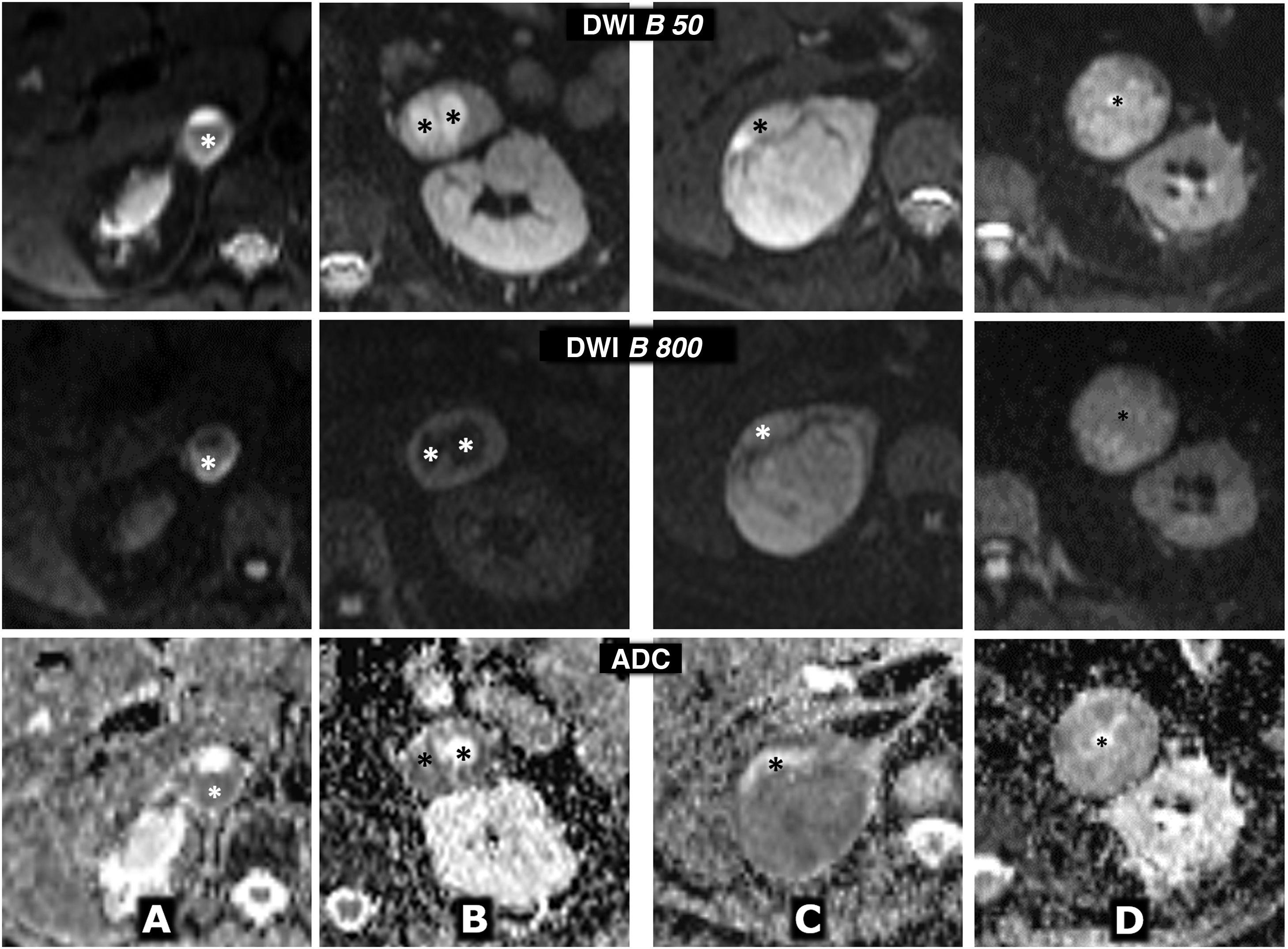 Adrenal pheochromocytoma: Keys to radiologic diagnosis | Radiología ...