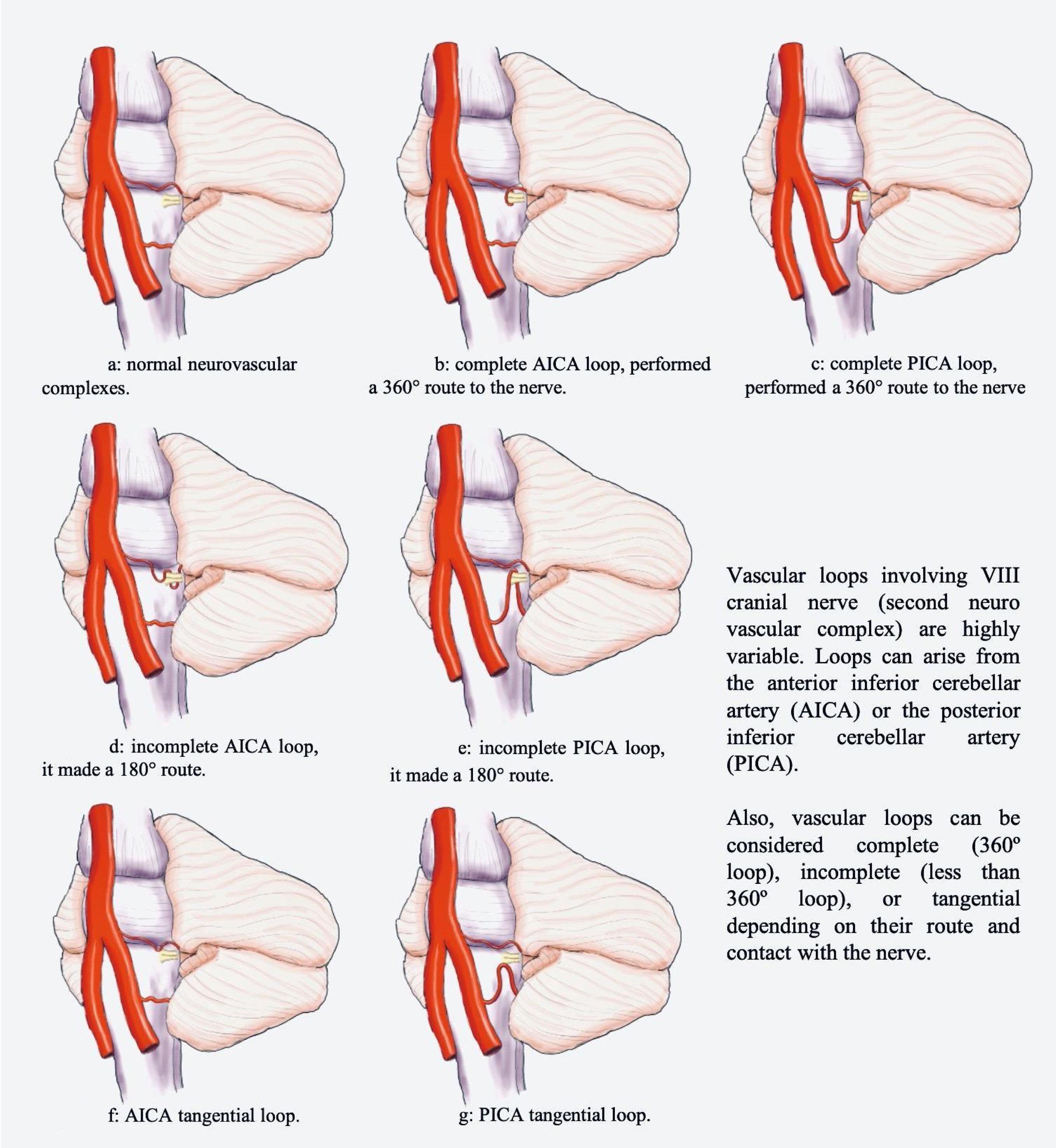Vascular loop in the cerebellopontine angle: Clinical-radiological ...