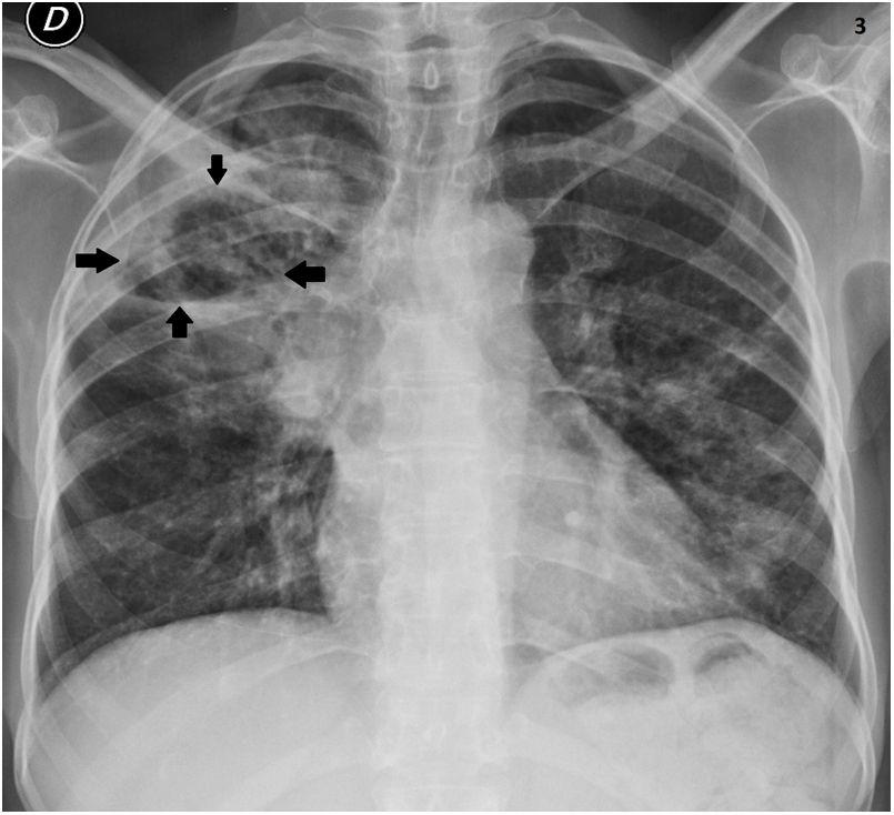 Blastomycosis Lung X Ray
