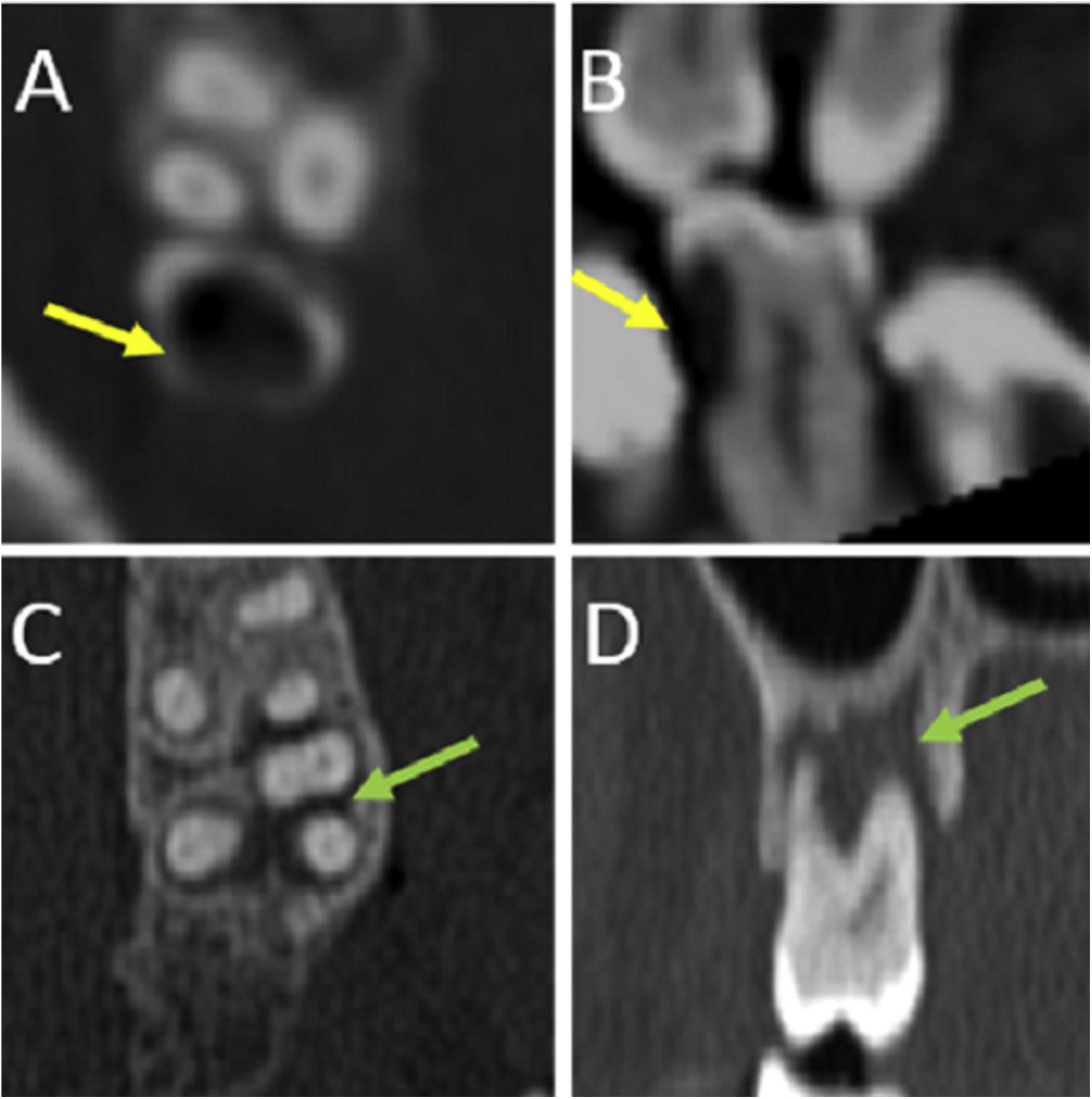 CT findings for dental disease | Radiología (English Edition)
