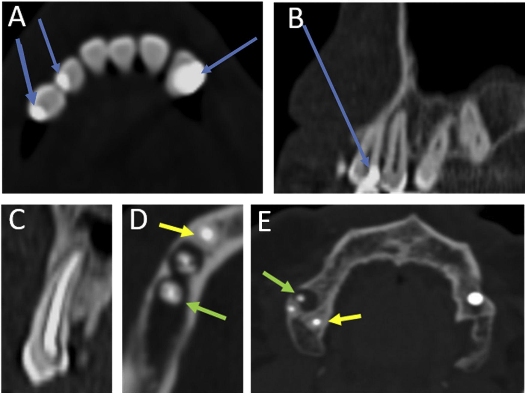 CT findings for dental disease | Radiología (English Edition)