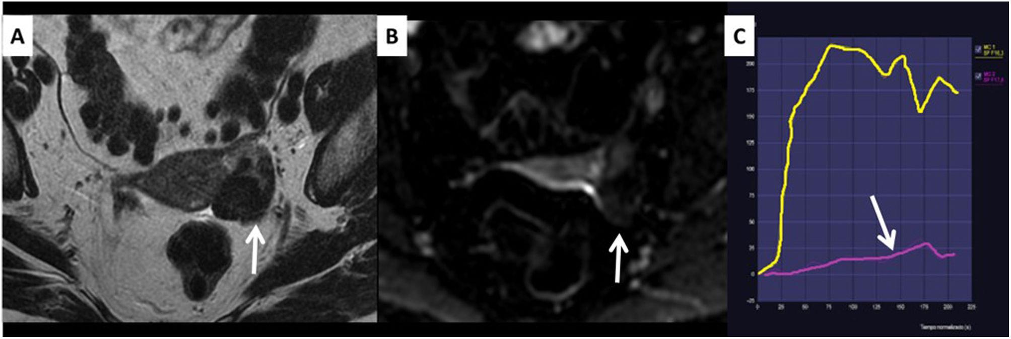 The O-RADS MRI score for the characterization of indeterminate ovarian ...