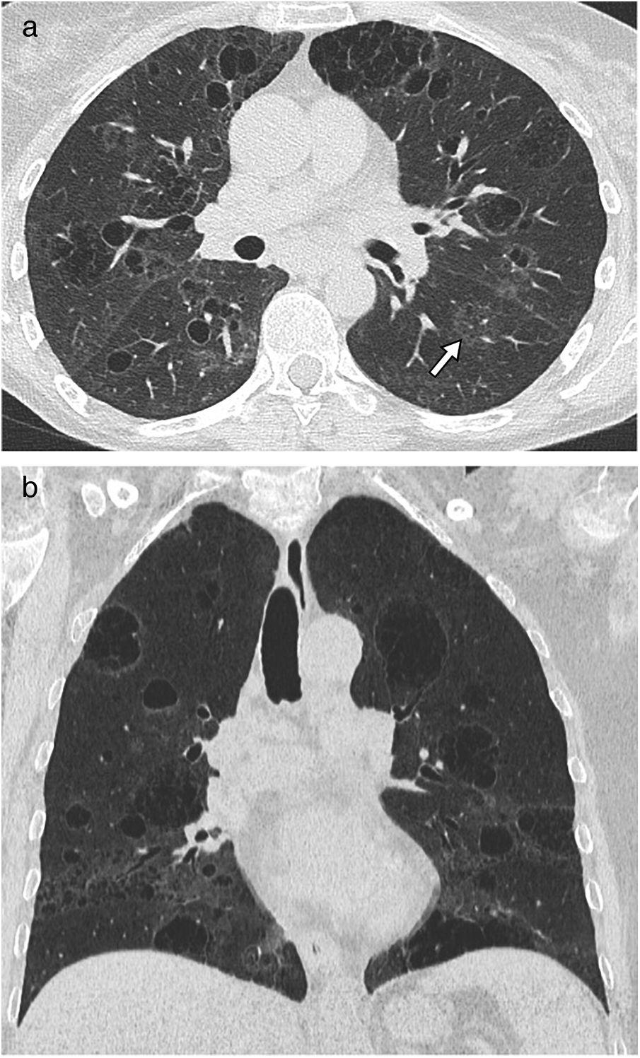 Cystic lung disease | Radiología (English Edition)