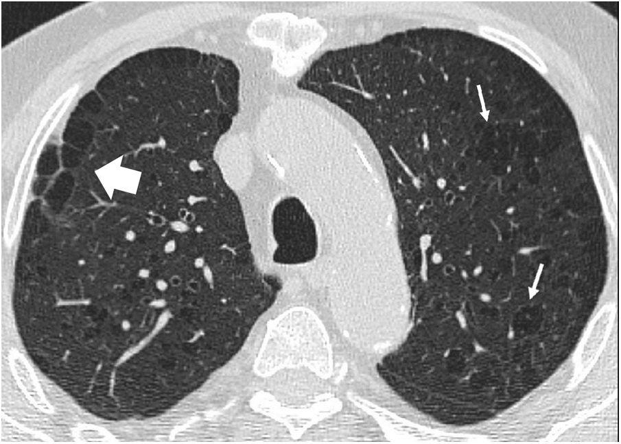 Cystic lung disease | Radiología (English Edition)