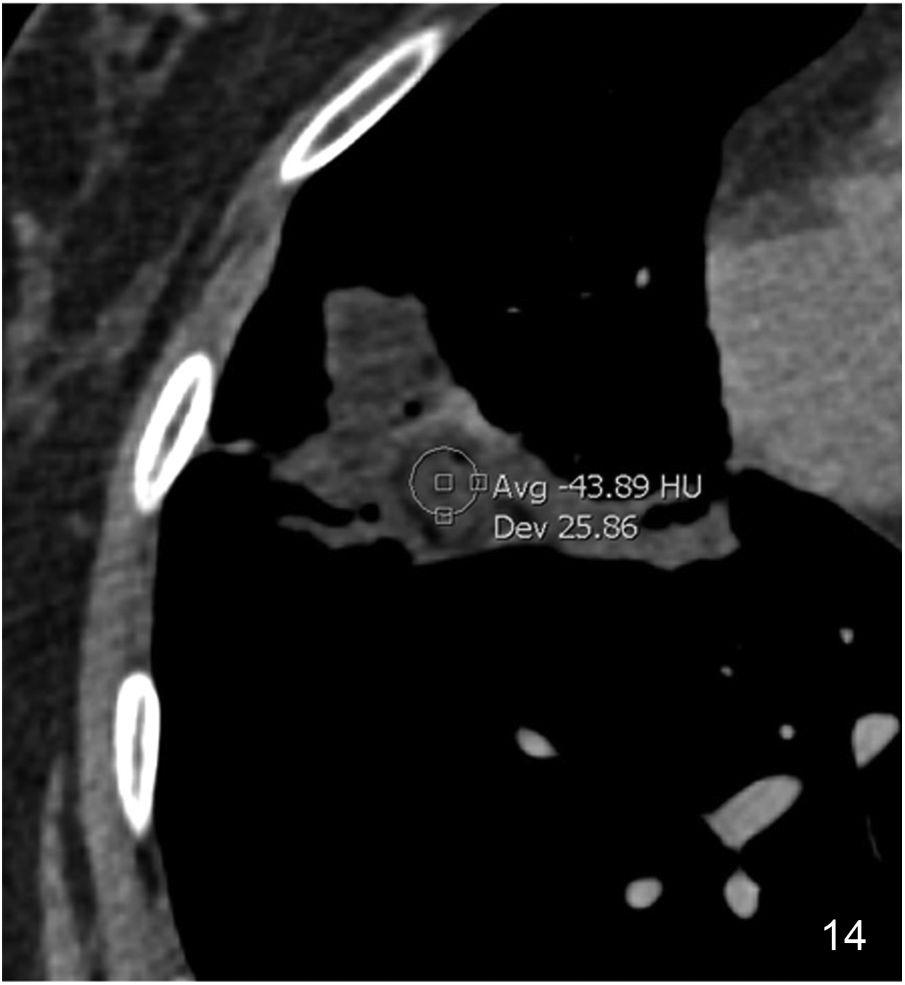 Basic HRCT patterns in diffuse interstitial lung disease | Radiología ...