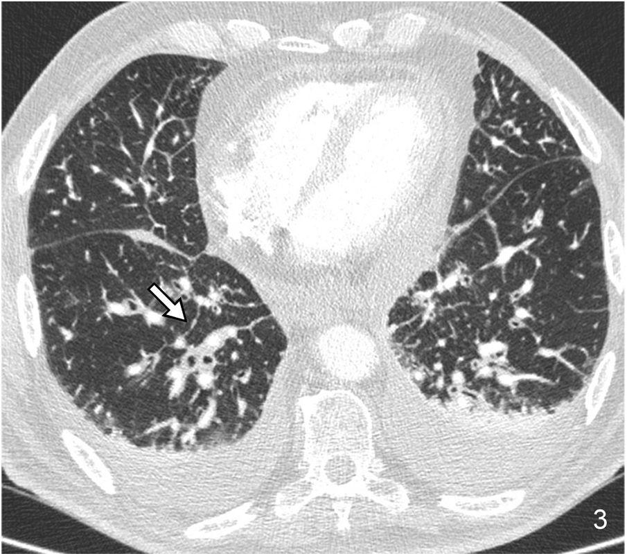 Basic HRCT patterns in diffuse interstitial lung disease | Radiología ...
