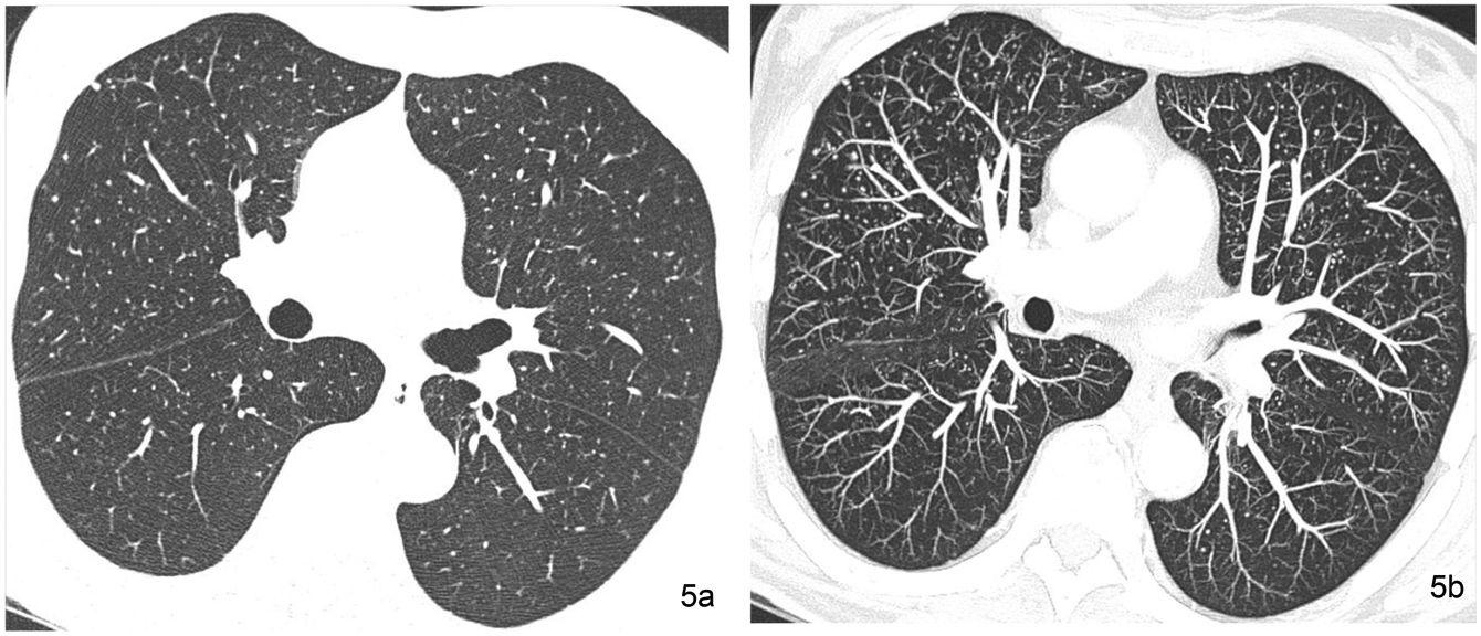 Basic HRCT patterns in diffuse interstitial lung disease | Radiología ...