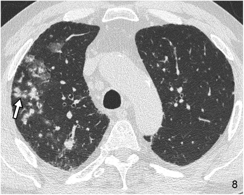 Basic HRCT patterns in diffuse interstitial lung disease | Radiología ...