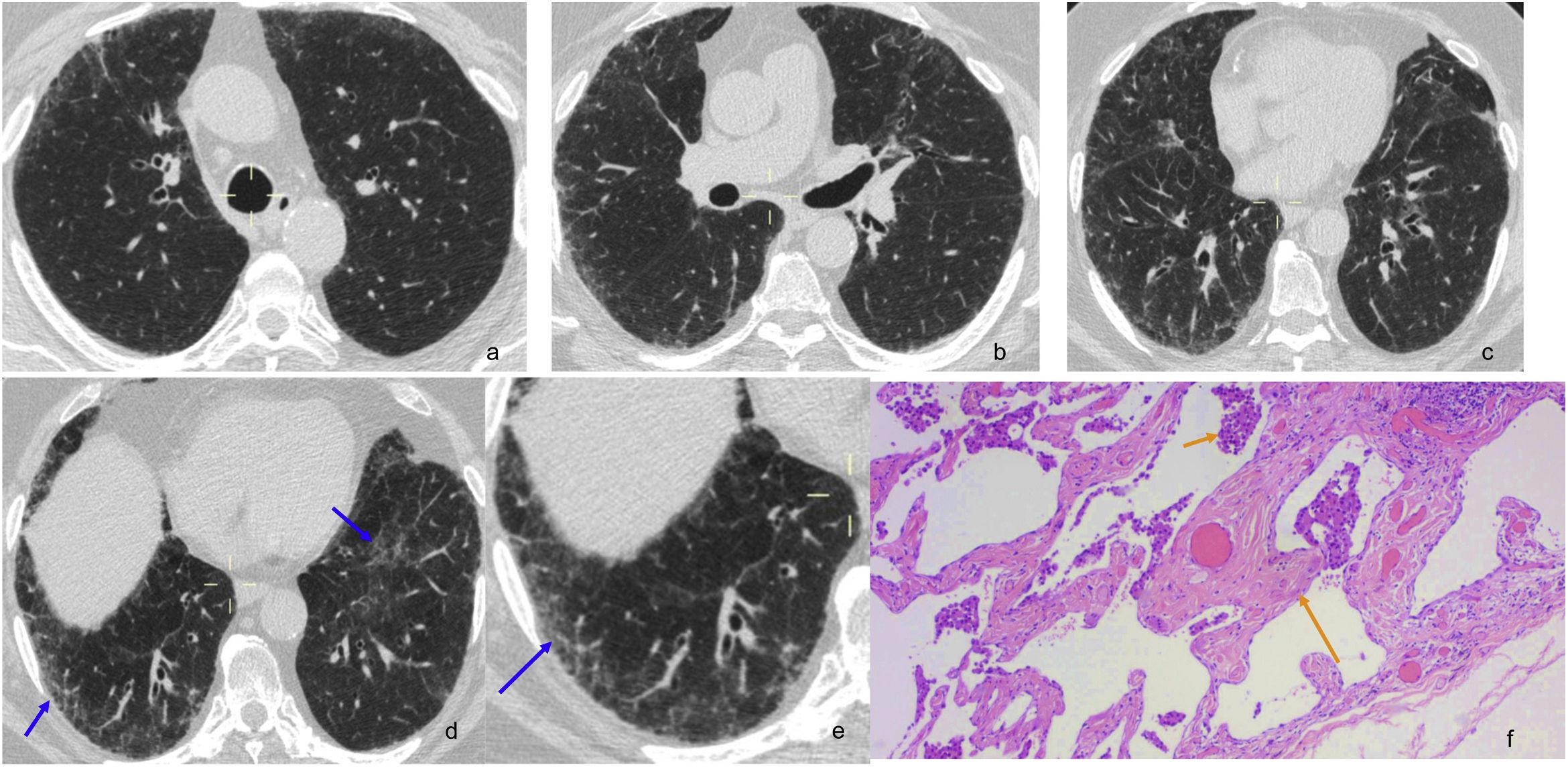 Smoking-related interstitial lung disease | Radiología (English Edition)