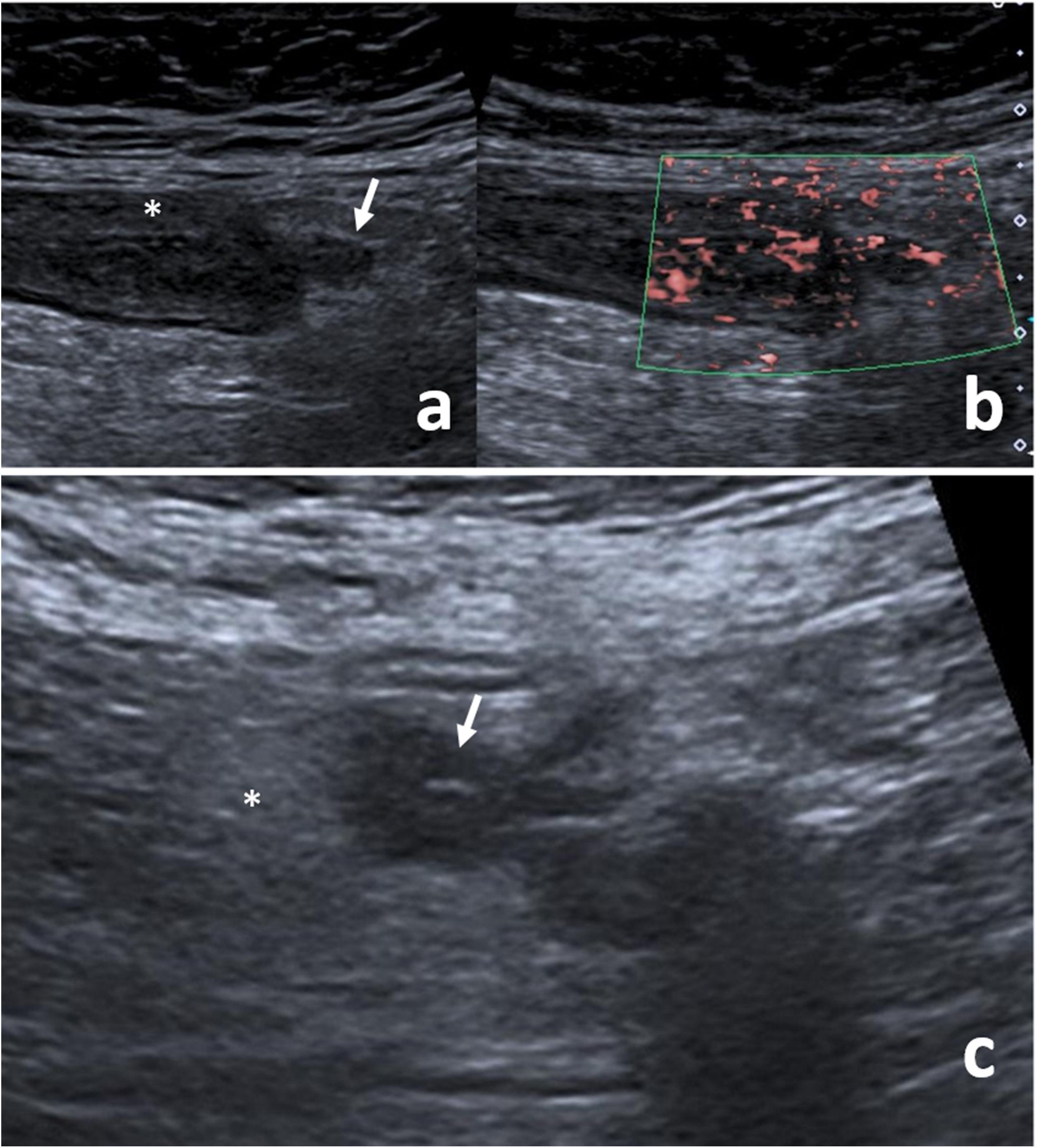 Classification of acute diverticulitis in the left colon with ...