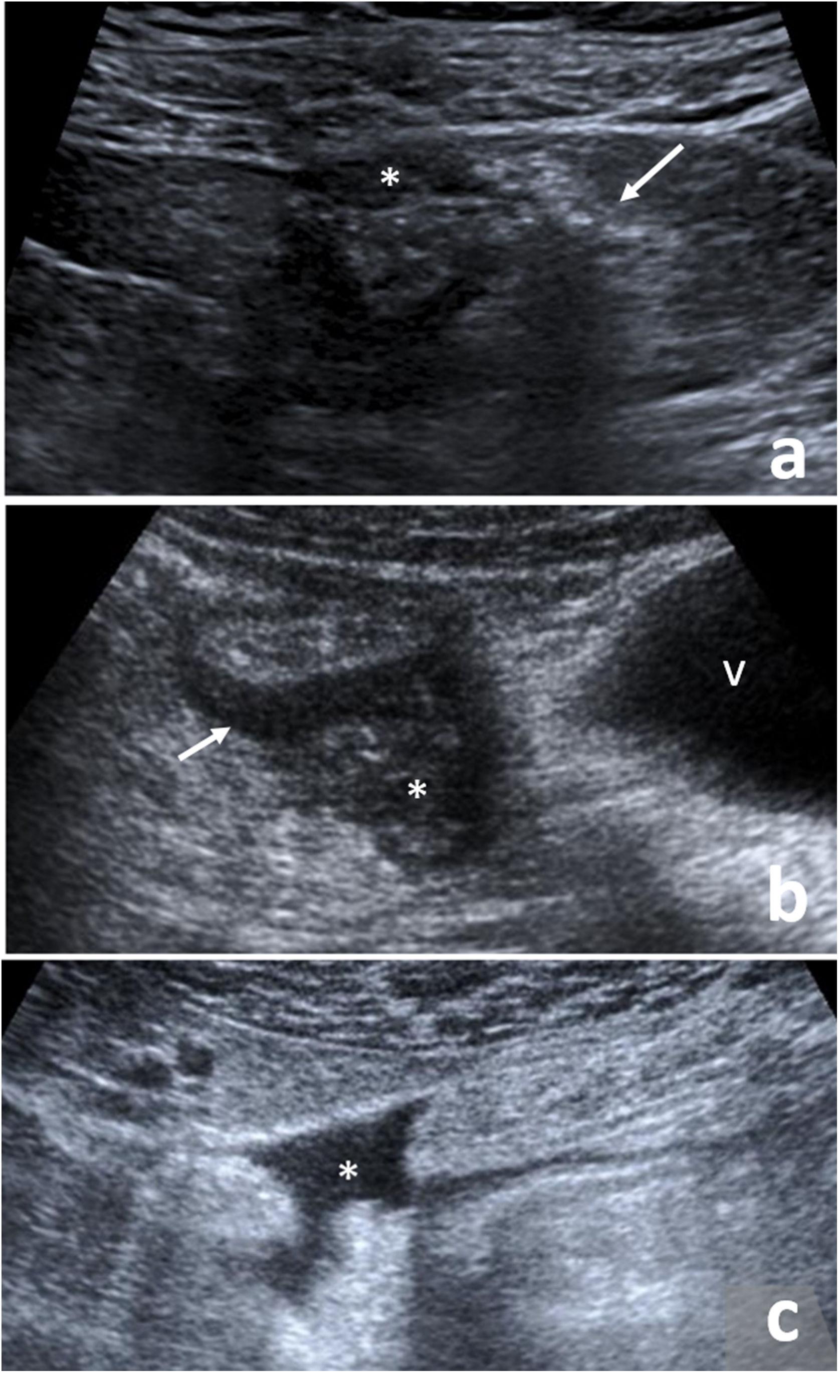 Classification of acute diverticulitis in the left colon with ...