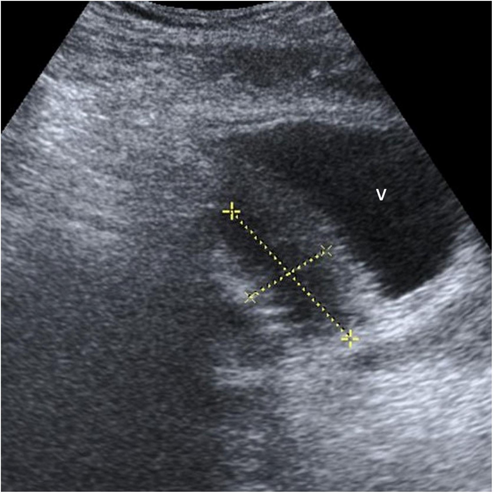 Classification of acute diverticulitis in the left colon with ...