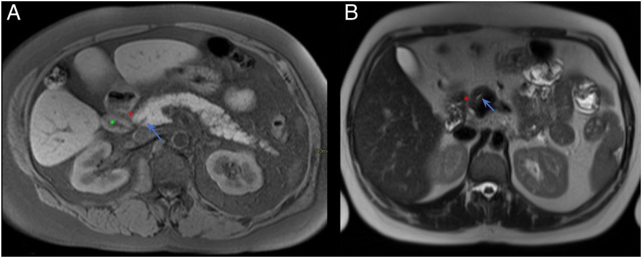 Groove pancreatitis and how to differentiate it from pancreatic ...