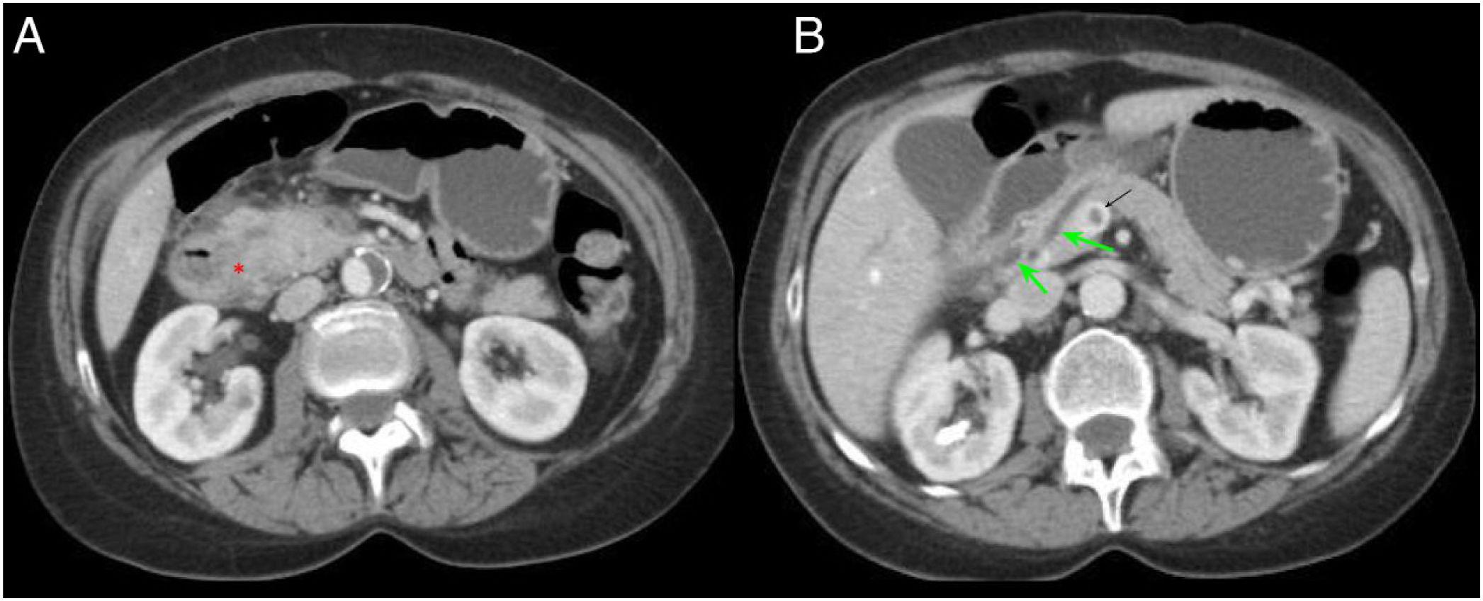 Groove pancreatitis and how to differentiate it from pancreatic ...